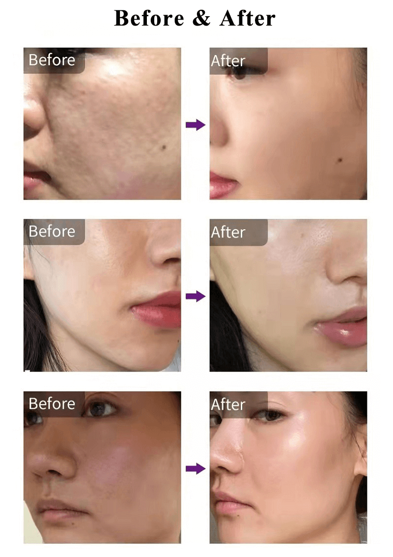 vital-injector-3_08 - Derma shine pro, Microneedling pen and serum ...